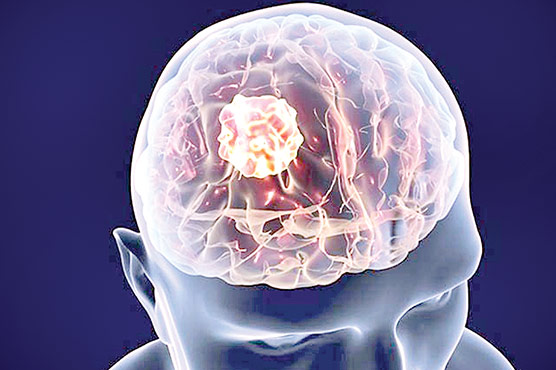 عجائب دنیا:-دماغی سرطان روکنے والی ویکسین پہلے مرحلے میں کامیاب